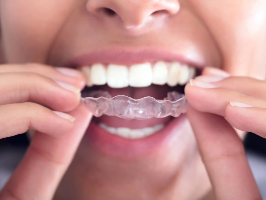 Enhance Your Child's Confidence with Invisalign Treatment